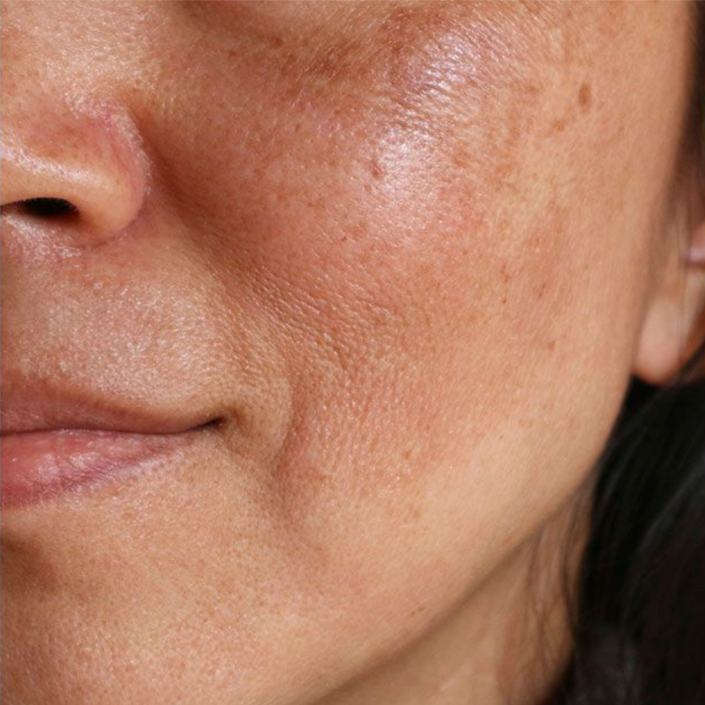 Hyperpigmentation Peel | SkinRoots